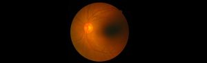 5 Facts You Should Know About Corneal Blindness - Centre For Sight