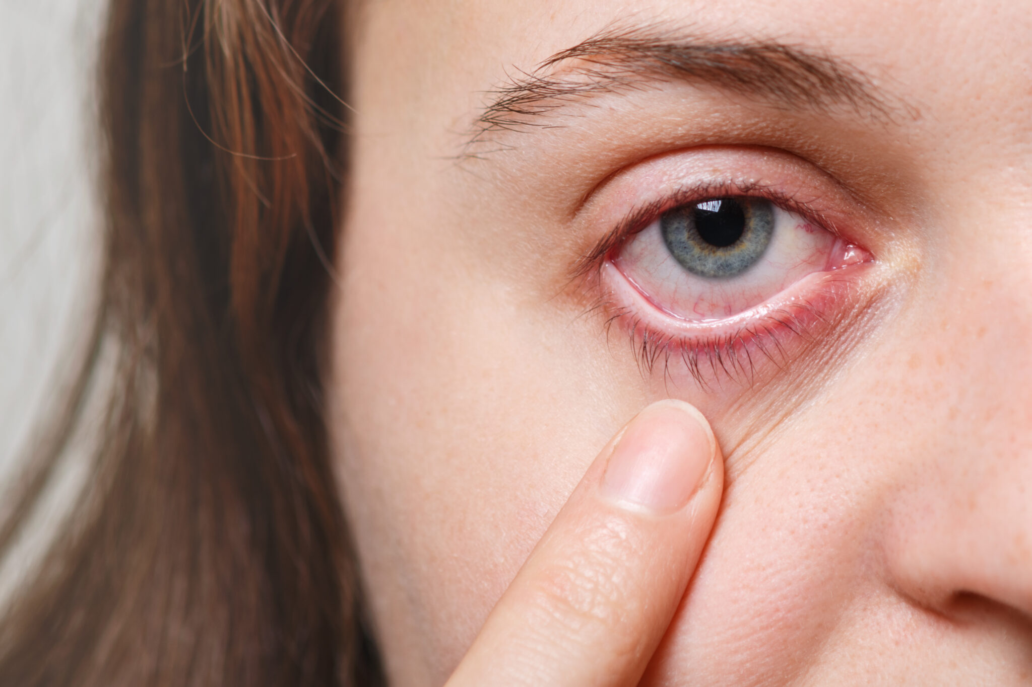 Uveitis- Symptoms, Causes, Types & Treatment