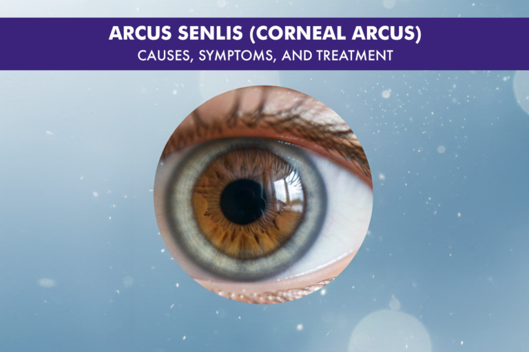 Arcus Senilis: Causes, Symptoms, Treatment & When to Worry