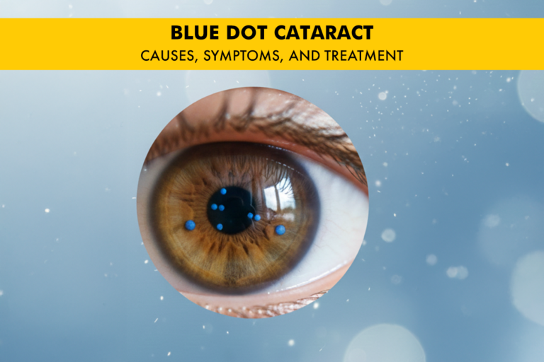 Blue Dot Cataract (Cerulean): Causes, Symptoms & Treatment