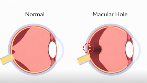 What is the Macula of the Eye? Function, Structure & Diseases